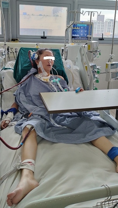 Suy đa tạng do lạm dụng corticoid tự điều trị cúm